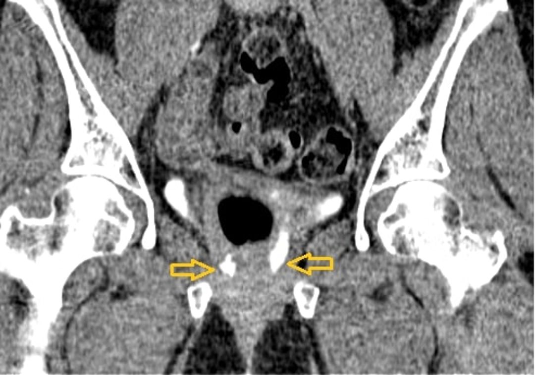 ICS 2020 Abstract #628 A quarternary repair of VVF: Transperitoneal ...