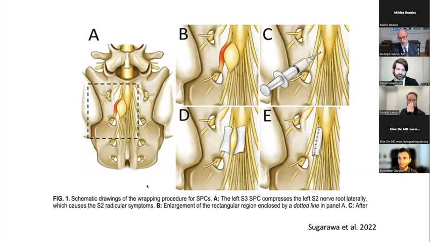 ICS | 3. Role of Spinal Radiculopathy with a Focus on Tarlov Cysts